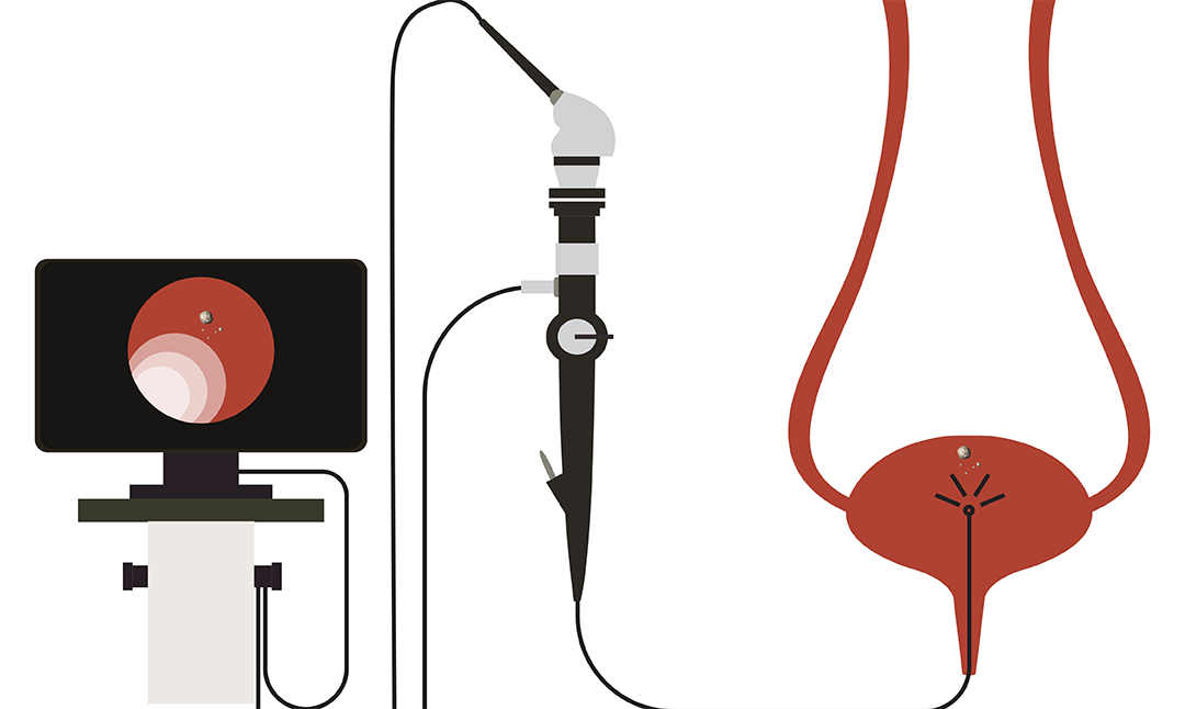 Ureteroscopic Lithotripsy Laser | Bahosi Hospital